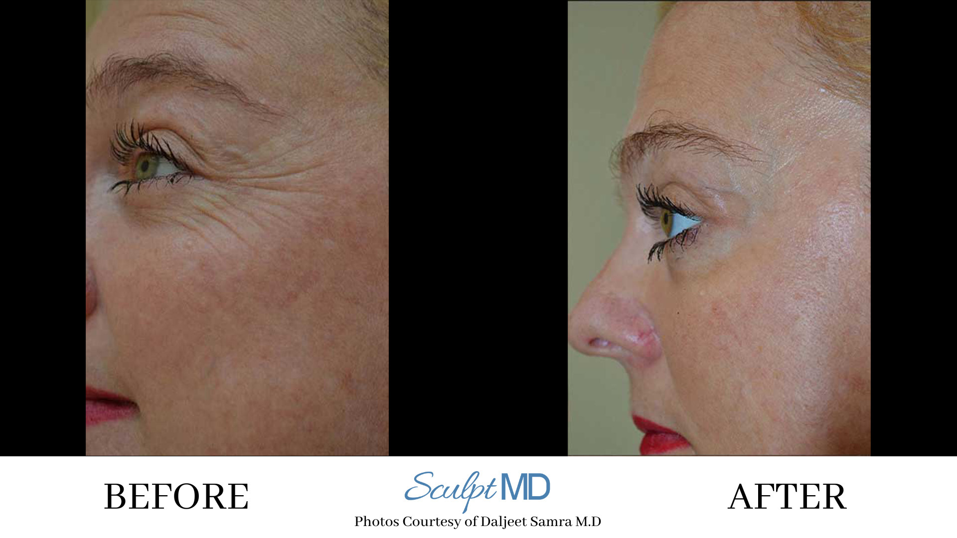 Skin Tightening Treatment in Livermore, CA | Sculpt MD