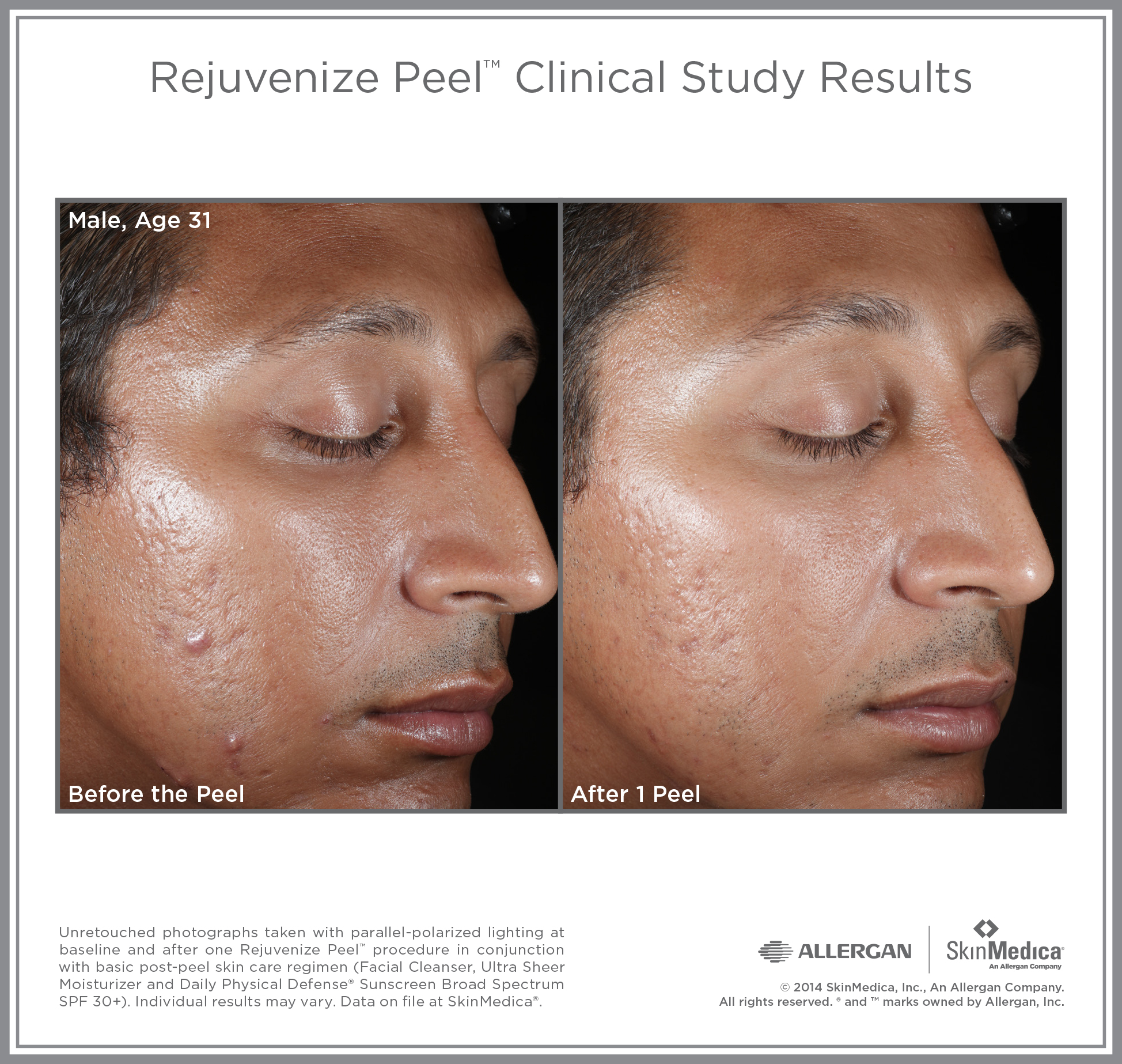 SkinMedica Chemical Peels Livermore | Sculpt MD