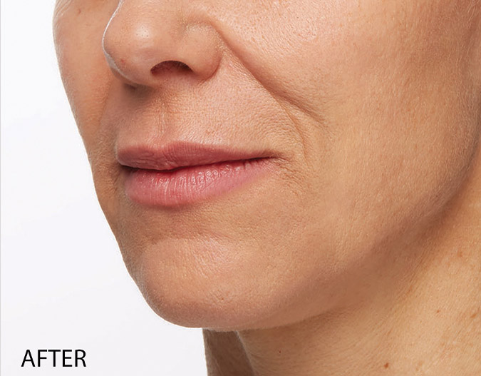 Restylane in Livermore | Youthful Skin at Sculpt MD
