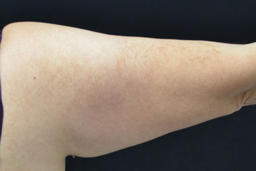 Emsculpt NEO | Sculpt MD | Livermore, CA
