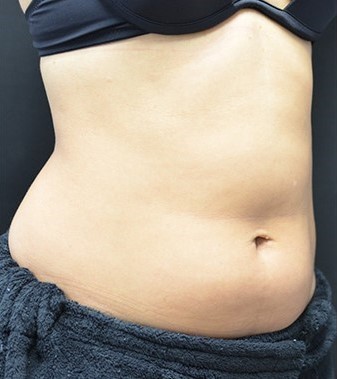 Abdomen - Sculpt MD