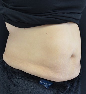 Abdomen - Sculpt MD