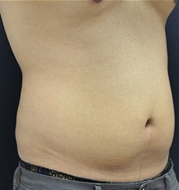 Abdomen - Sculpt MD