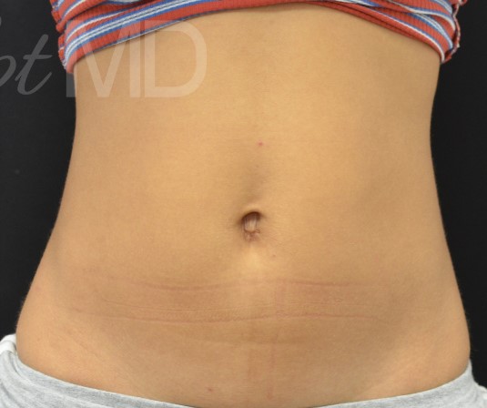 Abdomen - Sculpt MD