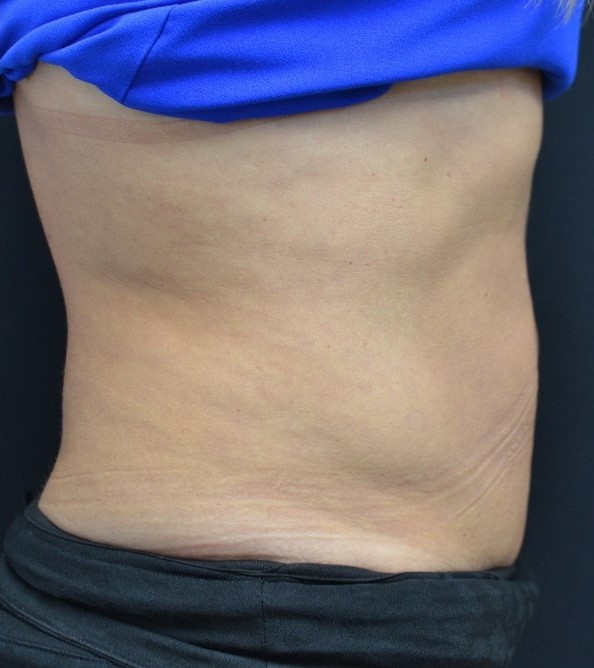 Abdomen - Sculpt MD