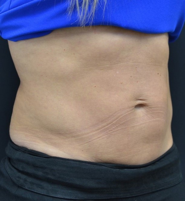 Abdomen - Sculpt MD