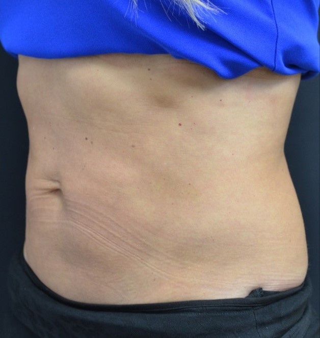 Abdomen - Sculpt MD