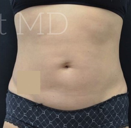 Abdomen - Sculpt MD