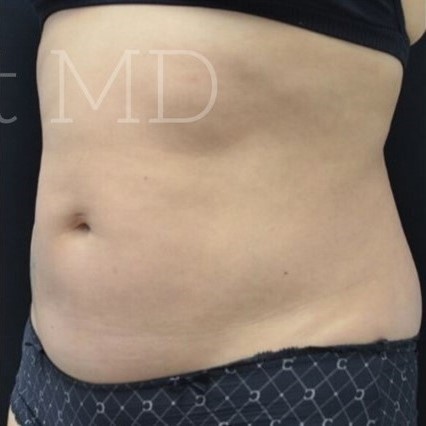 Abdomen - Sculpt MD
