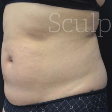 Abdomen - Sculpt MD