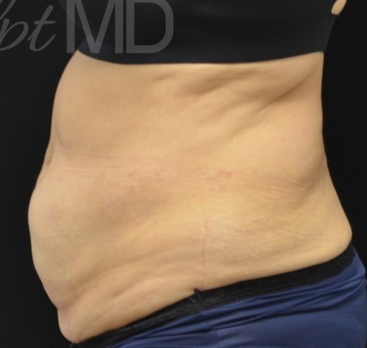 Abdomen - Sculpt MD
