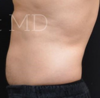 Abdomen - Sculpt MD