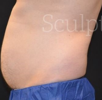 Abdomen - Sculpt MD