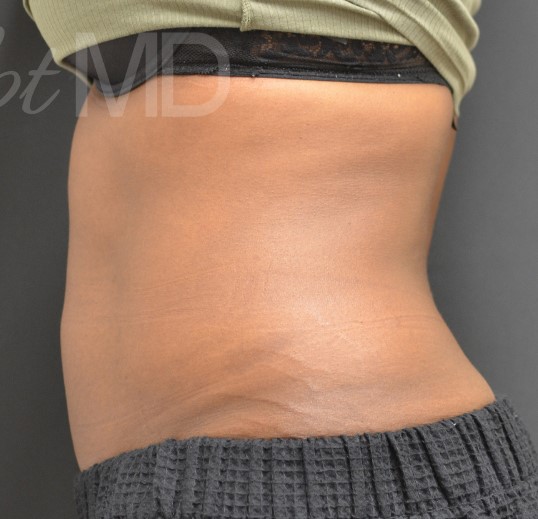 Abdomen - Sculpt MD