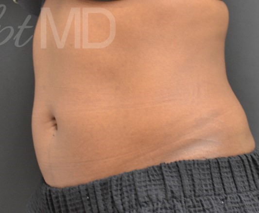 Abdomen - Sculpt MD