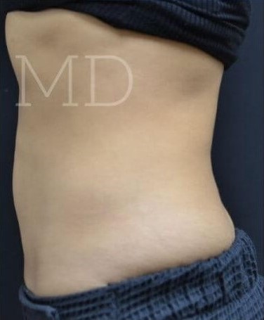 Abdomen - Sculpt MD