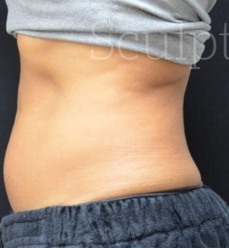Abdomen - Sculpt MD