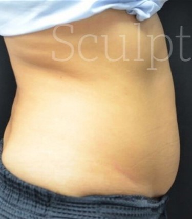 Abdomen - Sculpt MD