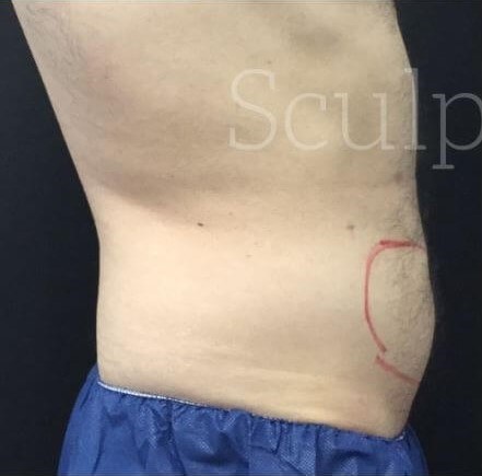 Abdomen - Sculpt MD