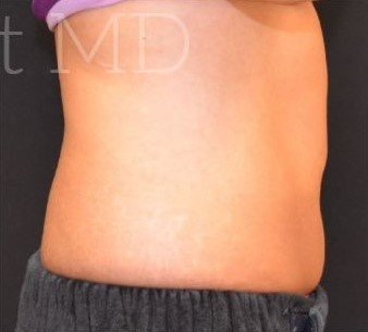 Abdomen - Sculpt MD