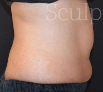 Abdomen - Sculpt MD