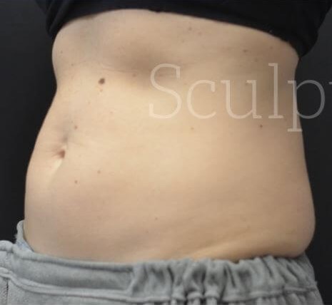 Abdomen - Sculpt MD