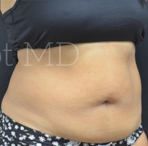 Abdomen - Sculpt MD