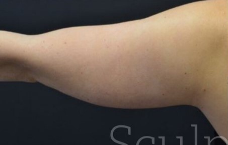 CoolSculpting Arm Before and After Photos | Sculpt MD Medspa