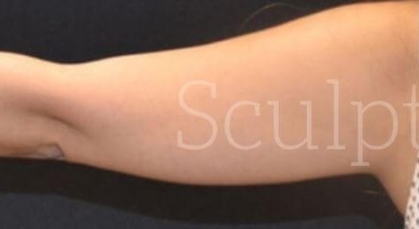 CoolSculpting Arm Before and After Photos | Sculpt MD Medspa