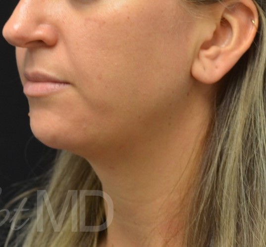 CoolSculpting Chin Before and After Photos | Sculpt MD Medspa