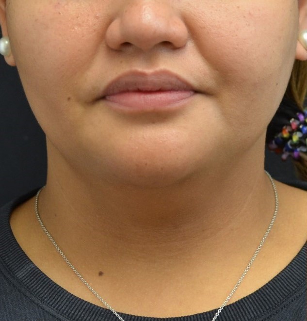 CoolSculpting Chin Before and After Photos | Sculpt MD Medspa