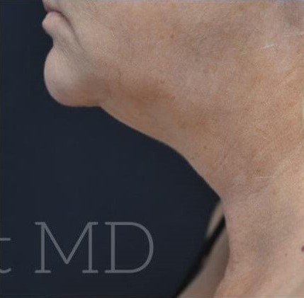 CoolSculpting Chin Before and After Photos | Sculpt MD Medspa
