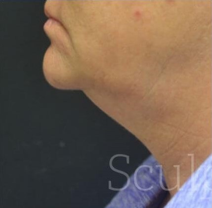 CoolSculpting Chin Before and After Photos | Sculpt MD Medspa
