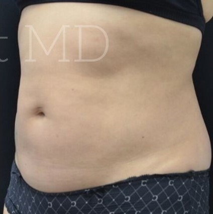 Flanks - Sculpt MD