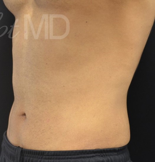 Abdomen - Sculpt MD