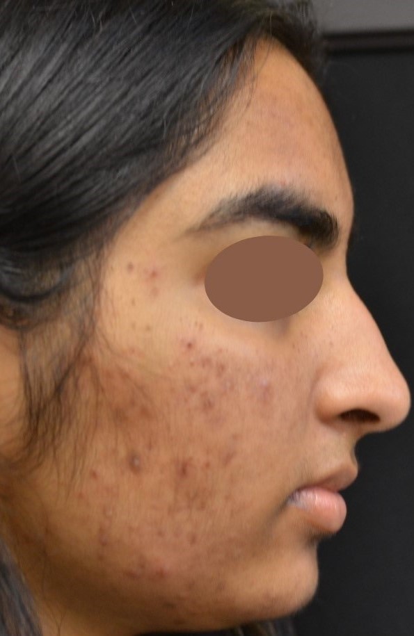 Esthetician Services Before and After Photos | Sculpt MD Medspa