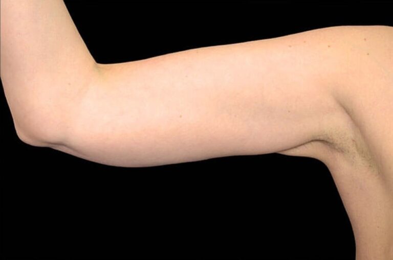 Exilis Skin Tightening Arms Before and After Photos | Sculpt MD Medspa