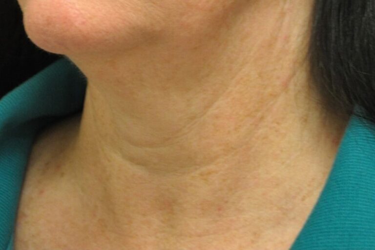 Exilis Skin Tightening Chin Before and After Photos | Sculpt MD Medspa