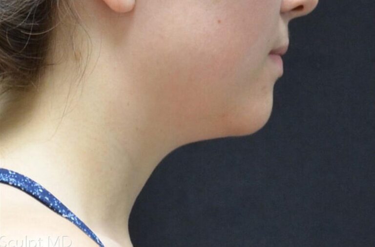 Exilis Skin Tightening Chin Before and After Photos | Sculpt MD Medspa