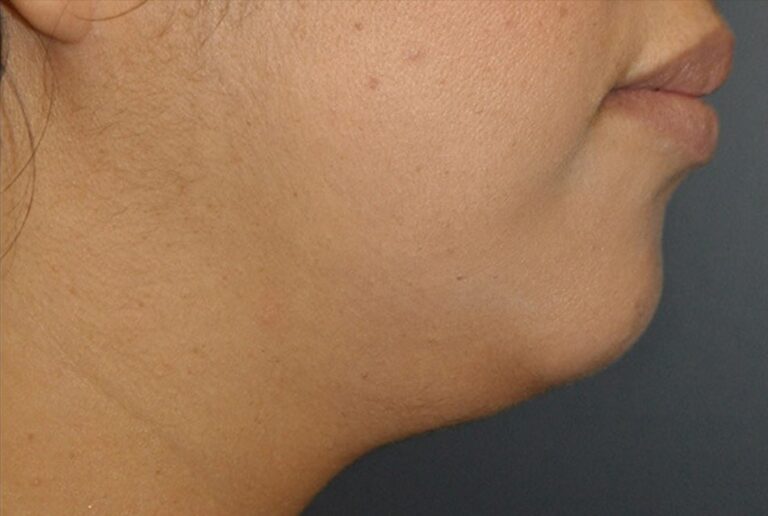 Exilis Skin Tightening Chin Before and After Photos | Sculpt MD Medspa