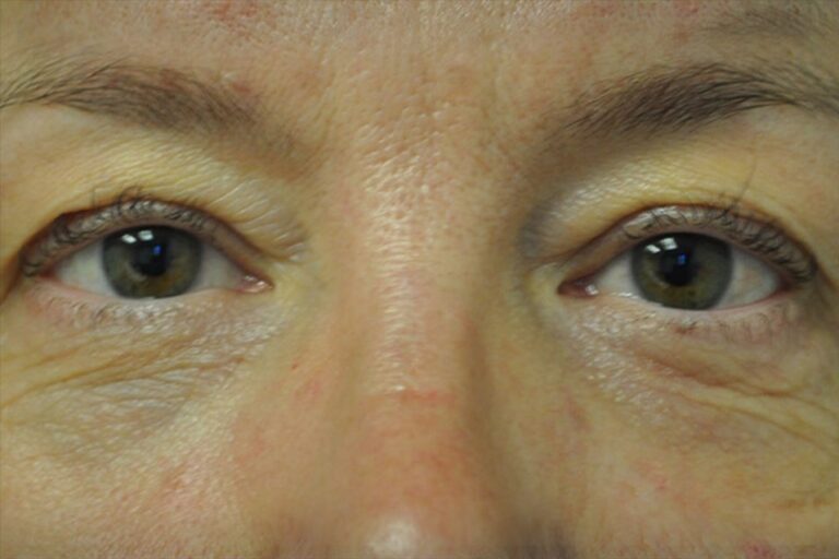 Exilis Skin Tightening Eyes Before and After Photos | Sculpt MD Medspa