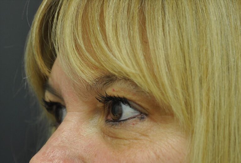 Exilis Skin Tightening Eyes Before and After Photos | Sculpt MD Medspa