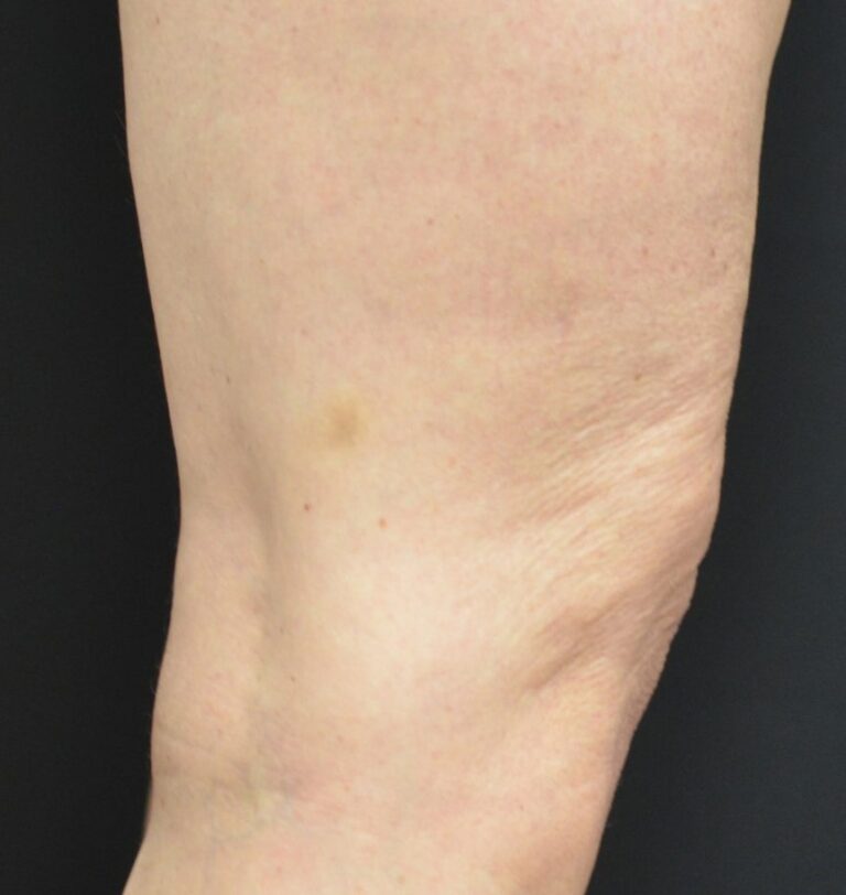 Skin Tightening Before and After 01 | Sculpt MD Medspa