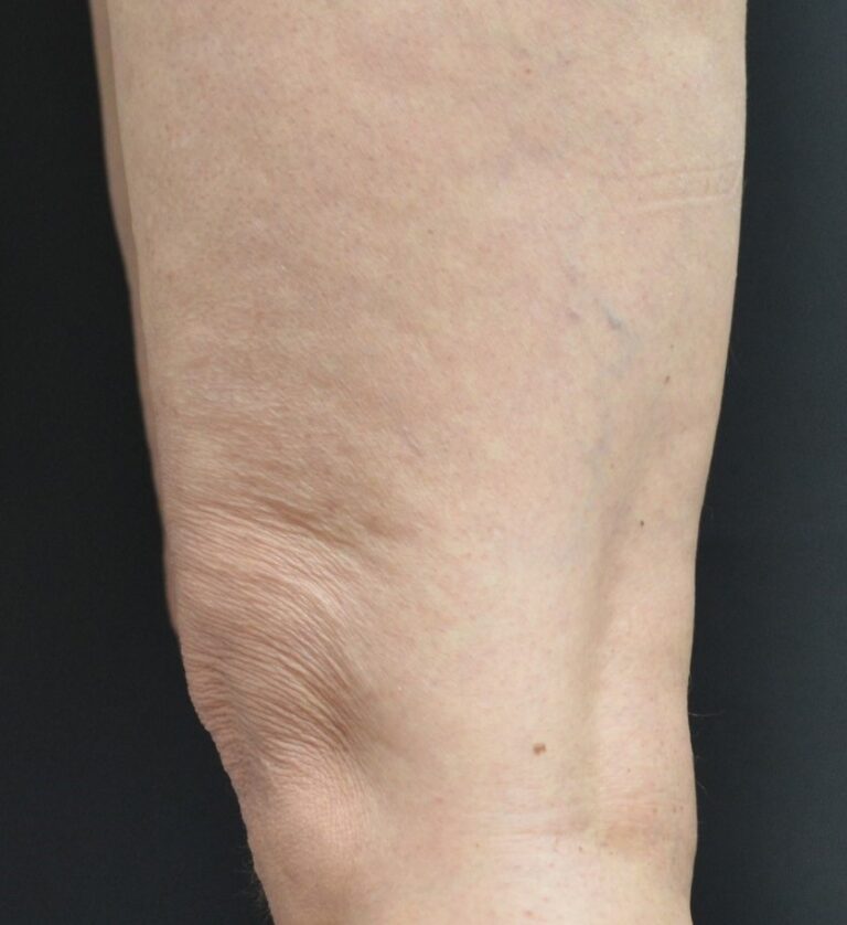 Skin Tightening Before and After 01 | Sculpt MD Medspa