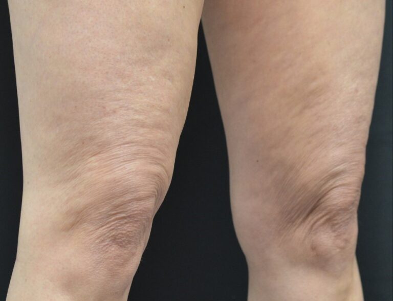 Skin Tightening Before And After 01 Sculpt MD Medspa Skin Tightening Before And After 01 Sculpt MD Medspa