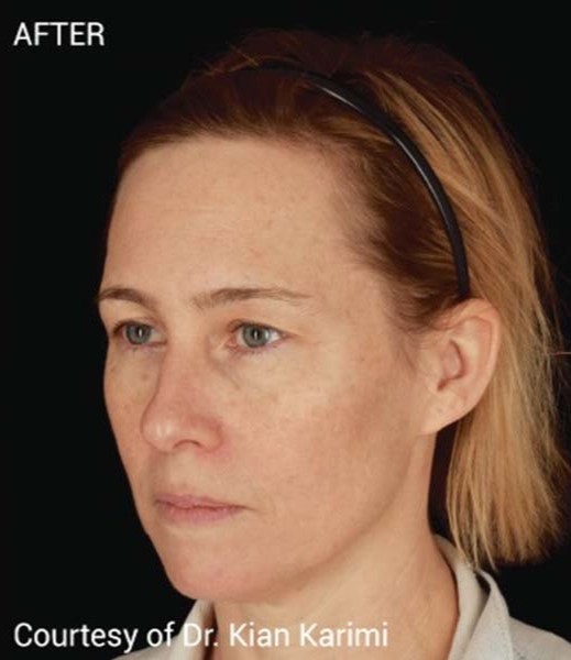 Microneedling With PRF Before and After | Sculpt MD Medspa