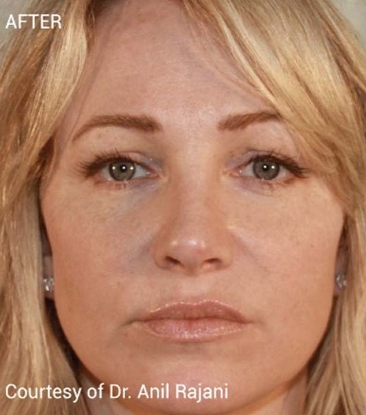 Microneedling With PRF Before and After | Sculpt MD Medspa