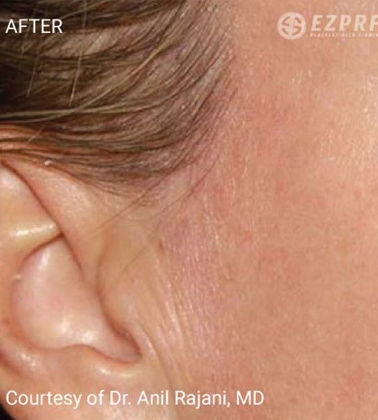 Microneedling With PRF Before and After | Sculpt MD Medspa