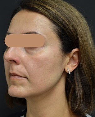 PRF Filler - Sculpt MD