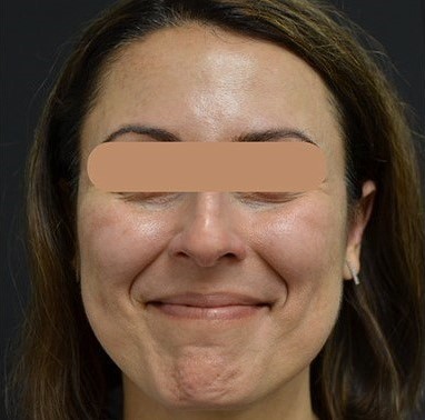 PRF Filler Before and After Photos | Sculpt MD Medspa
